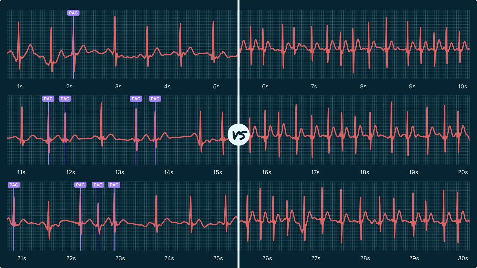 Supraventricular Tachycardia (Non-Sustained) Vs. Atrial Fibrillation on Your Watch ECG | Qaly